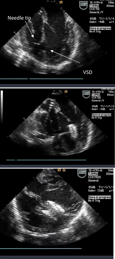 Per Ventricular VSD Device Closure A Needle Across VSD B Left Download Scientific Diagram