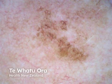 Lentigo Maligna Image