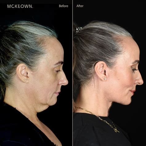 Jowl Lift Tighten Saggy Jowls Dr Darren Mckeown