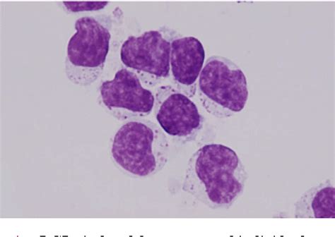 Large Granular Lymphocytic Leukemia Prognosis