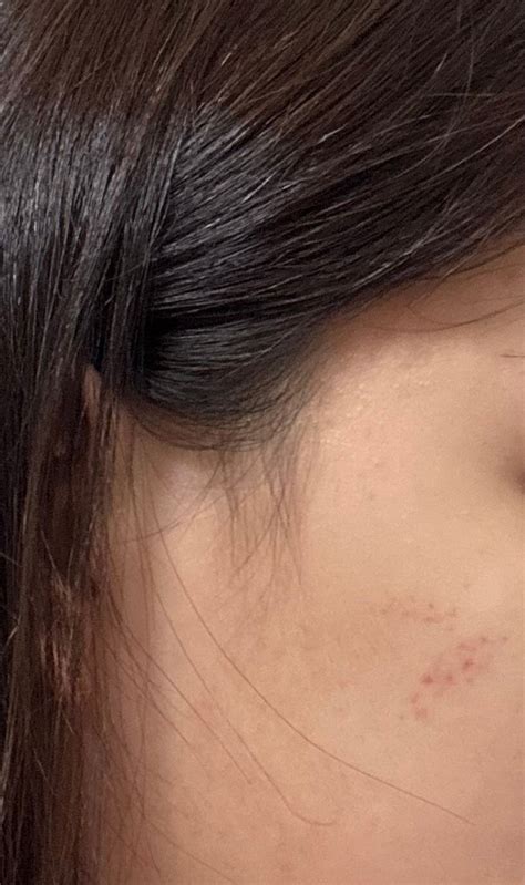 얼굴에 붉은점들 지식in