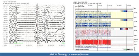 Eeg Monitoring In The Icu Medlink Neurology