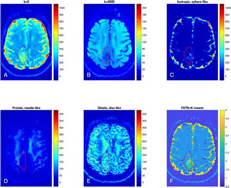Frontiers Measurement Of Full Diffusion Tensor Distribution Using High Gradient Diffusion Mri