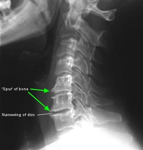 Osteophytes Lumbar Spine