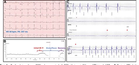 Figure 1 From Vasovagal Syncope With Isolated Atrioventricular Block Following