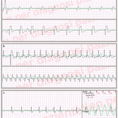 A Examples Of Pulseless Electrical Activity Pea In Two Different Download Scientific