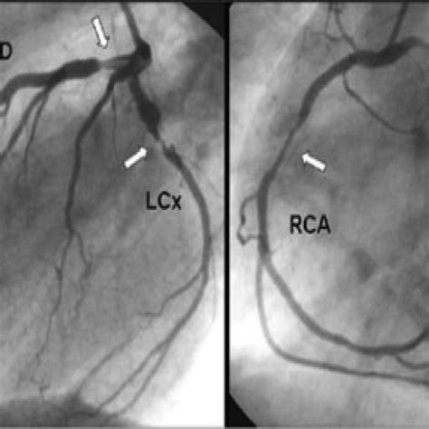 Cxr Revealing Ccf And Interstitial Pulmonary Edema Download Scientific Diagram