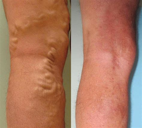 Varicose Veins Before And After Photos Milwaukee Wi