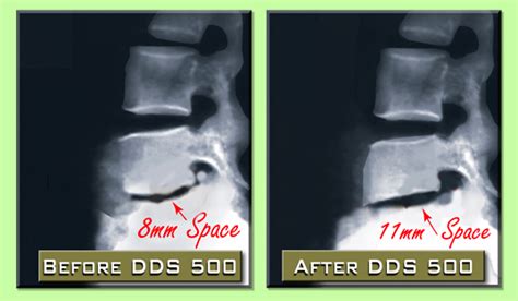 Back Brace Dds Belt Back Pain Relief