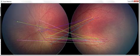 C Feature Detection And Matching Retinal Images Stack Overflow