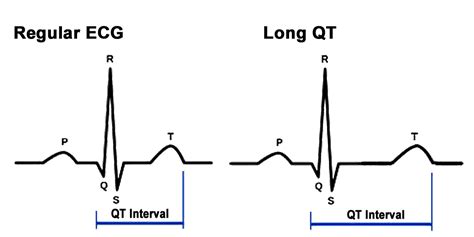 Qt Prolongation Of The Heart