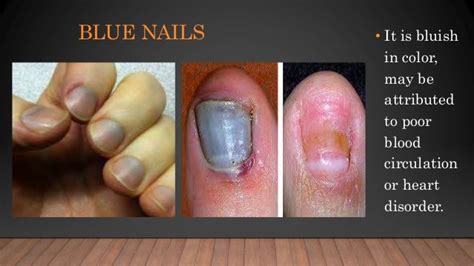 Nail Diseases And Disorders Poster