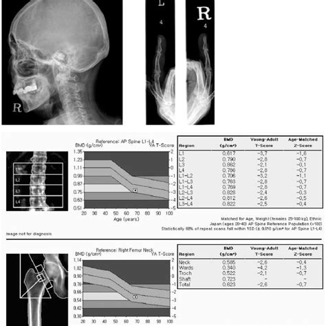 Radiologic Findings Of Hyperparathyroidism A Skull X Ray Shows Download Scientific Diagram