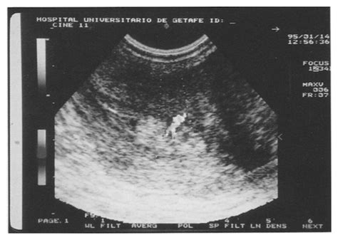 Color Doppler Shows Vessels In The Polyp Stalk Download Scientific