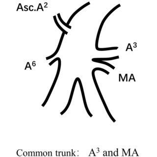 The RPA Branching Patterns Of Interlobar Portion RPA Right Pulmonary Download Scientific
