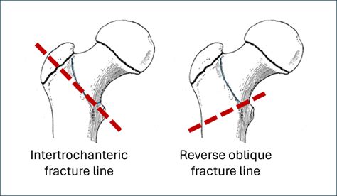 Neck Of Femur Nof Fractures Scrub Book