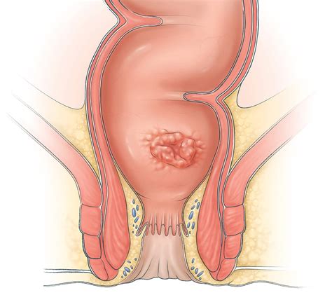Rectal Cancer In Younger Adults Symptoms Risk And Screening Aga Gi