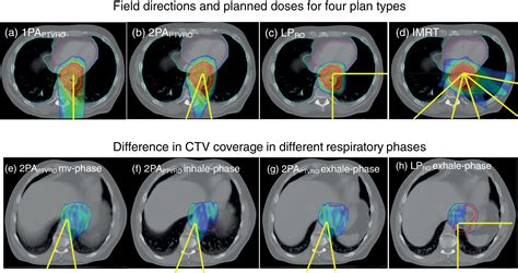 Pencil Beam Scanning Proton Radiation Therapy The Best Picture Of Beam