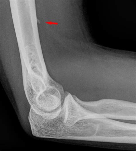 Supracondylar Process Of The Humerus Alchetron The Free Social Encyclopedia
