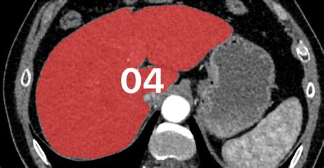 Automatic Liver Segmentation Part 4 4 Train And Test The Model Pycad