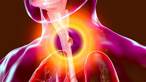 Esophageal Cancer Throat Cancer Warning Signs You Should Know