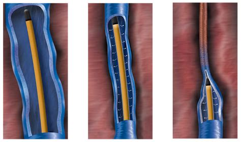 Radiofrequency Ablation For Chronic Venous Insufficiency Cvi