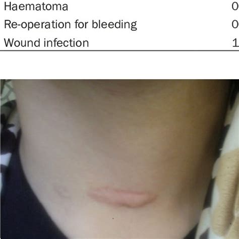 Classification Of The Different Minimally Invasive Thyroidectomy Techniques Download Table