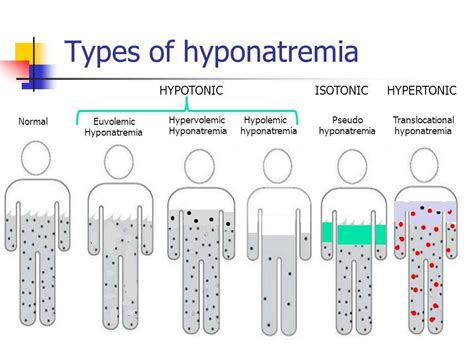 Hyponatremia