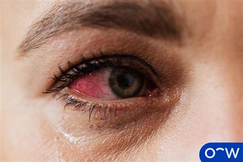 Conjunctivitis