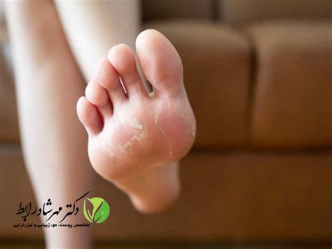 فرق اگزما و قارچ پوستی عکس