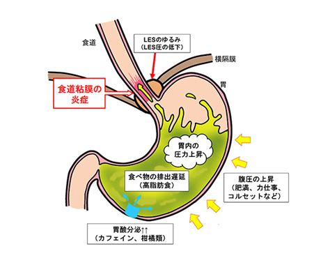 西宮で胃食道逆流症（逆流性食道炎）の治療なら【ほその内科 おなかクリニック】