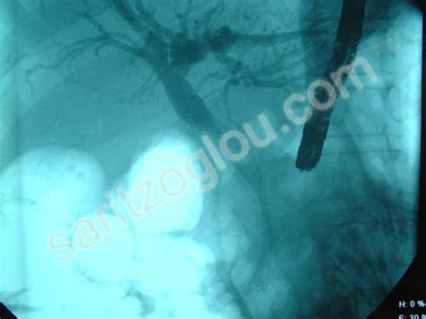 ERCP ενδείξεις επεμβατική ενδοσκόπηση διάγνωση θεραπεία