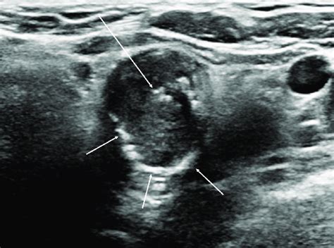 A 63 Year Old Woman With A 2 0 Cm Left Thyroid Lobe Nodule The Download Scientific Diagram