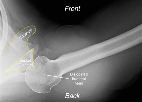 What If My Shoulder Dislocates To The Back Some Treatment Options For Posterior Shoulder