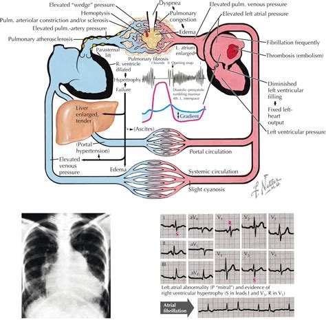 Mitral Valve Disease Clinical Tree