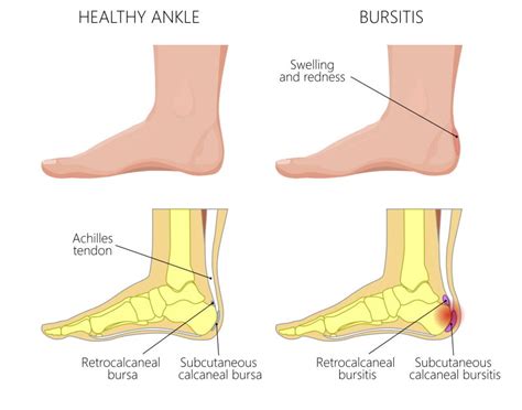 Heel Bursitis Demystified Symptoms And Solutions