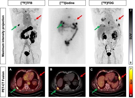 Heterogeneous Disease Pattern 71 Y Old Man With Follicular Thyroid