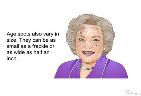 Age Spots