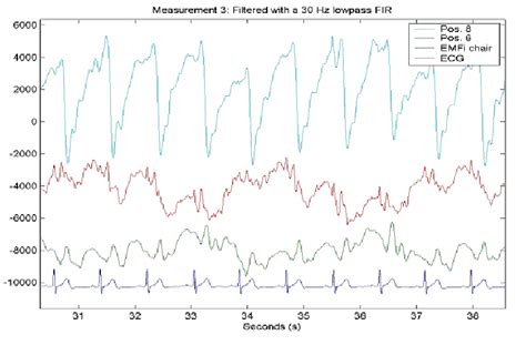 Measurement 3 Leg During Normal Respiration Signals Shown