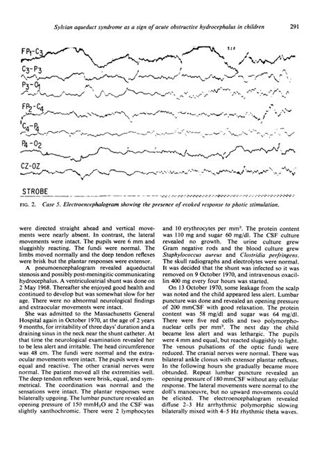 Sylvian Aqueduct Syndrome As A Sign Of Acute Obstructive Hydrocephalus