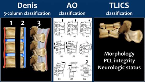 Tlics Vs Ao Classification Of Thoracolumbar Fractures John 51 Off