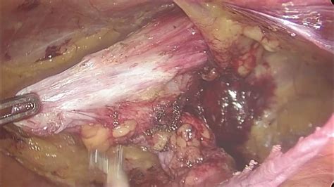 Transabdominal Preperitoneal Youtube