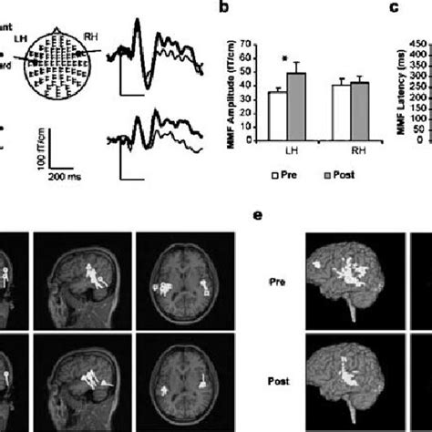 Pdf Neural Plasticity In Speech Acquisition And Learning