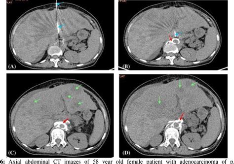Figure 6 From Role Of Ct Guided Celiac Plexus Block For Intractable