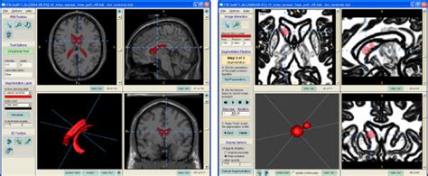 Left Itk Snap User Interface Shows Three Orthogonal Views Of A