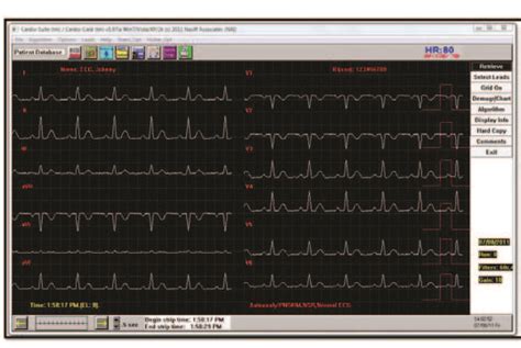 Nasiff Cardioresting Pc Based Ecg System Cc Ecg1