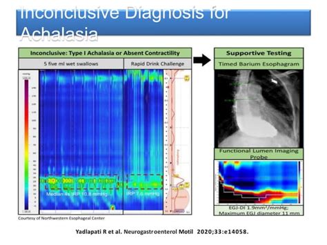 Chicago Classification Version 40 Hrm Classification Of Esophageal