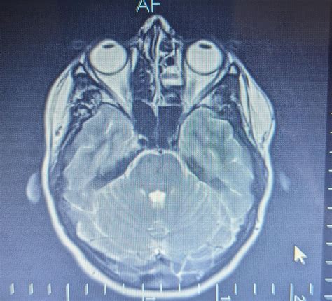 39 Year Old Female With Left Hemifacial Atrophy Post Free Flap Surgery