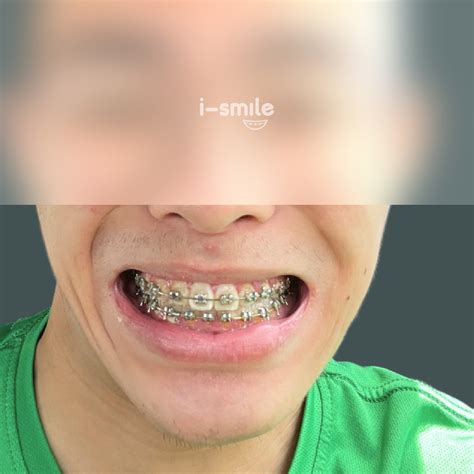 Braces I Smile