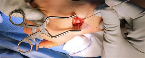 Scaphoid Open Reduction And Internal Fixation Through Dorsal Approach Journal Of Medical Insight